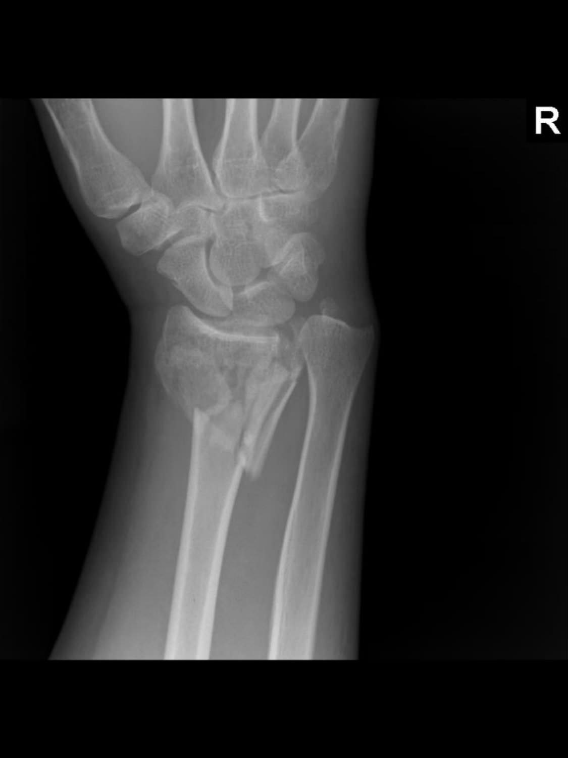 Shattered Wrist Broken Wrist Volar Plate Fixation Wrist Surgeon Dr ...